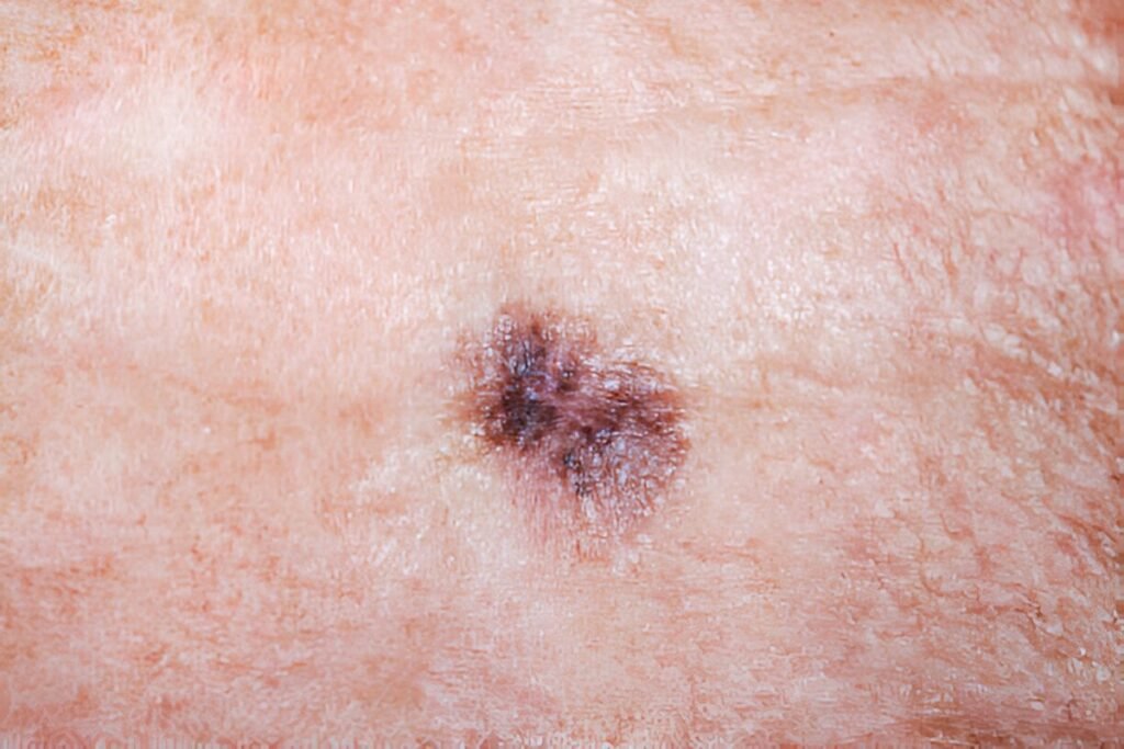Melanoma Skin Cancer Has Reached An All Time High In The Uk According To A Survey Storymag